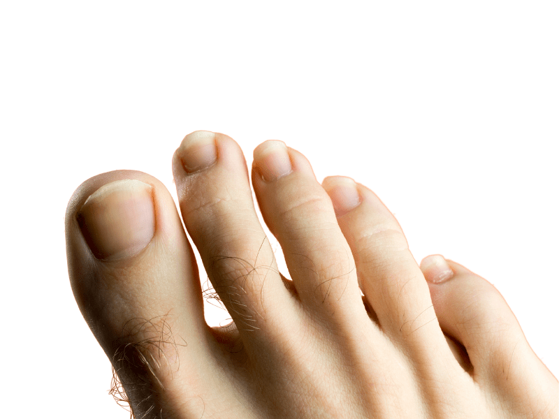 Mallet Toes | Foot Foundation