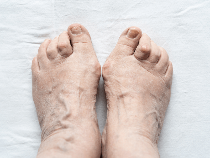 Hammer Toes | Foot Foundation