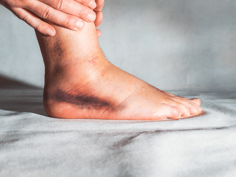 Posterior Tibial Tendon Dysfunction | Foot Foundation